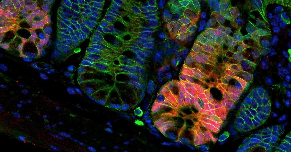 Neoplasie in costante aumento. L'appello: "Subito il Registro dei ...
